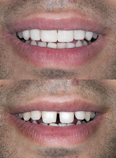 5 Ways to Fix Your Bad Teeth Forever - Moms Austin