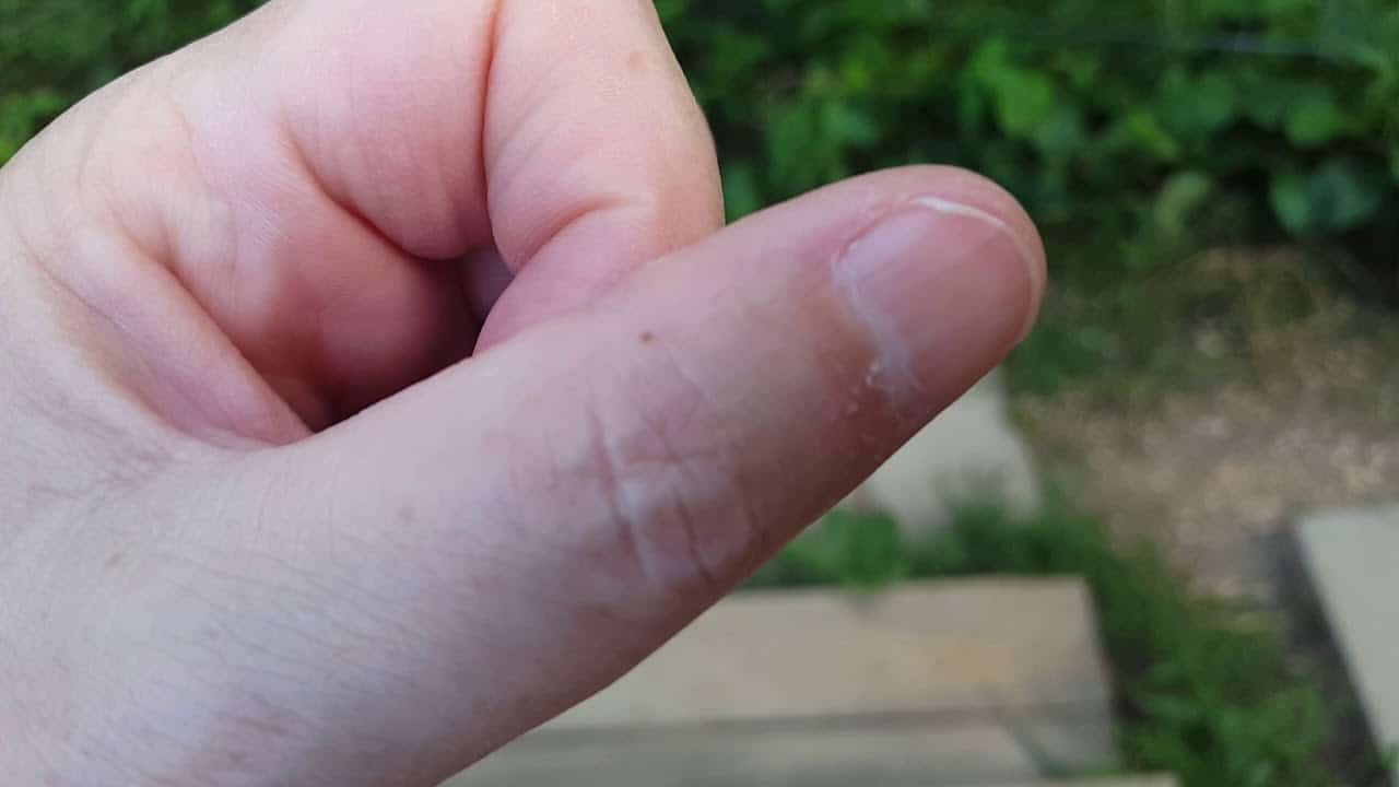 How to Get Seed Ticks Out of Clothes and Shoes (Without Chemicals ...